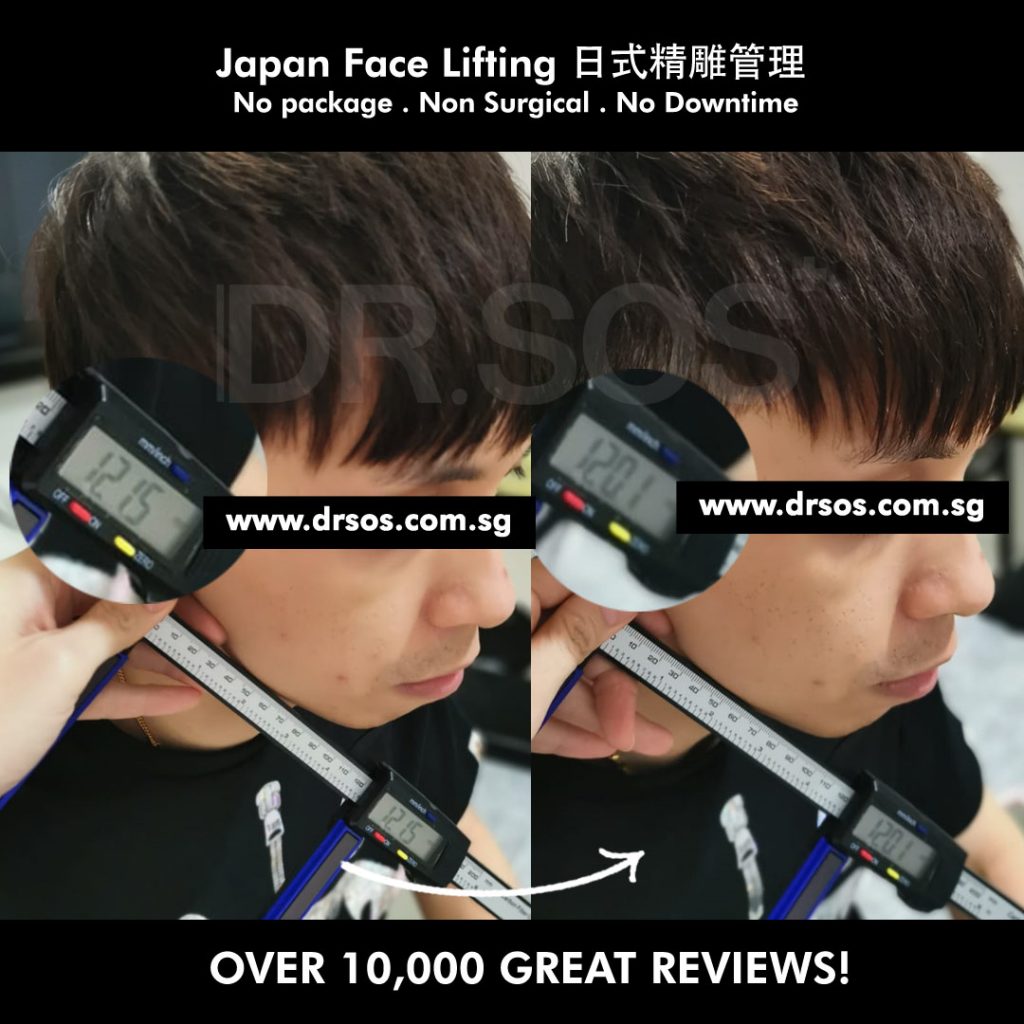 Japan Face Lifting - Visible Result in 1 Session! - Dr SOS