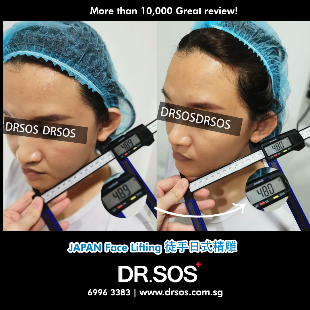 Japan Face Lifting - Visible Result in 1 Session! - Dr SOS