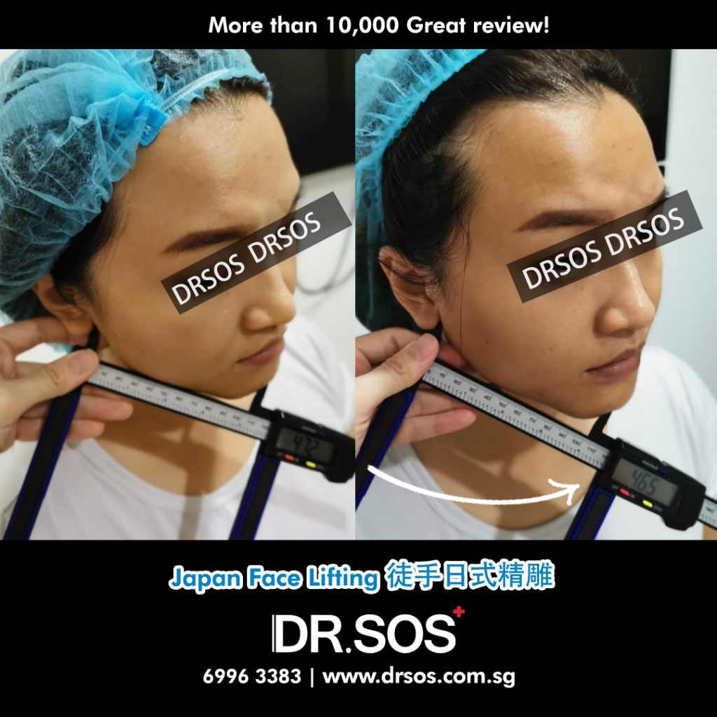 Japan Face Lifting - Visible Result in 1 Session! - Dr SOS