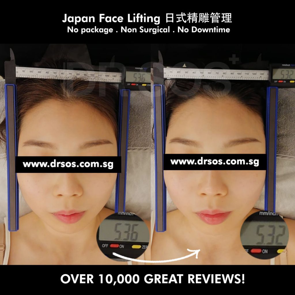 Japan Face Lifting – Visible Result in 1 Session! – Dr. SOS