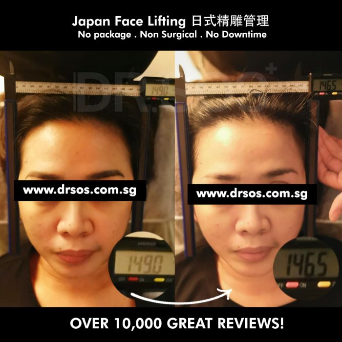 Japan Face Lifting – Visible Result in 1 Session! – Dr. SOS