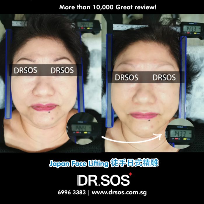 Japan Face Lifting - Visible Result in 1 Session! - Dr SOS